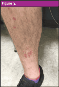 Guttate Psoriasis: An Uncommon Cause of a Rash | Journal of Urgent Care ...