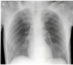 CE4RT - Radiographic Positioning of the Chest for X-ray Techs