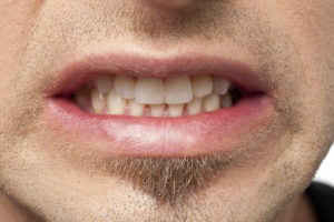 Teeth Clenching | Causes and effects, Treatment suggestions