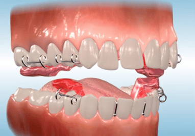 Orthodontic Appliances - Texas Orthodontic Specialists
