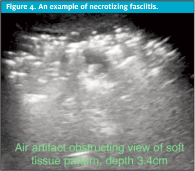 Utility of POCUS in Skin and Soft Tissue Infection | Journal of Urgent ...