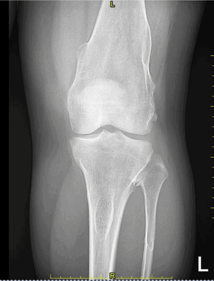 A 30-Year-Old Female with Bilateral Knee Pain | Journal of Urgent Care ...