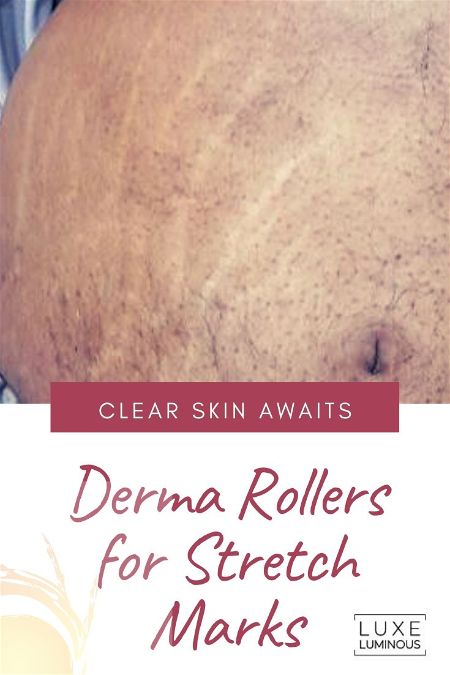 Derma Roller for Stretch Marks. Microneedling Treatments - Luxe Luminous