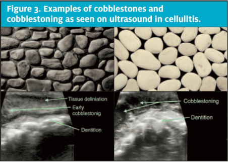 Utility of POCUS in Skin and Soft Tissue Infection | Journal of Urgent ...