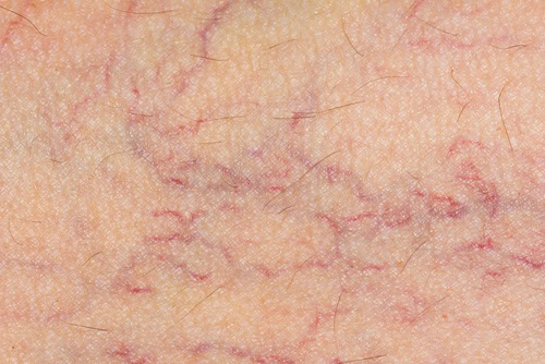 Treat Varicose Veins Naturally During Pregnancy American Pregnancy Association