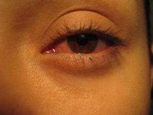 Evaluation of Infectious Conjunctivitis by Clinical Evaluation and ...