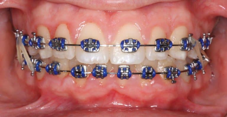 ORTODONCIA FIJA ¿CÓMO FUNCIONAN LOS BRACKETS METÁLICOS CONVENCIONALES ...