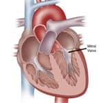 Endoscopic Robotic Mitral Valve Repair