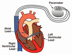 Robotic Pacemaker Lead Placement, Cardiac Resynchronization Therapy