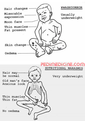 Protein Energy Malnutrition