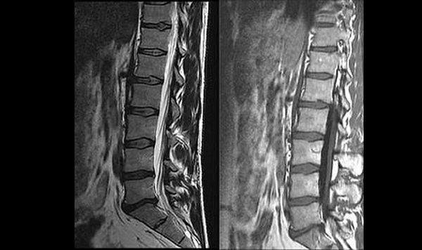 Resonancia Magnética De Columna Lumbar Con Contraste Preventor