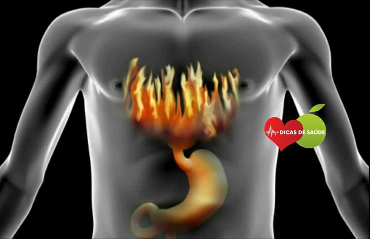 Azia - O que é, Causa, Sintomas e Tratamentos 【ATUALIZADO】