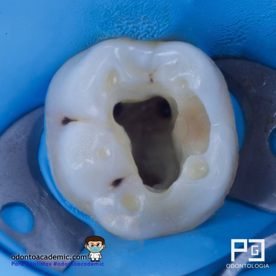 Endodoncia, Tratamiento de Conductos en Primer Molar Inferior ...