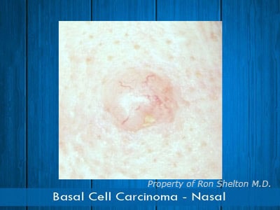 Skin Cancer New York | Basal Cell Carcinoma - Ron Shelton MD