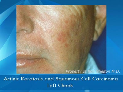 Squamous Cell Carcinoma NYC | Actinic Keratosis treatment for skin cancer