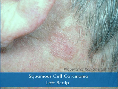 Squamous Cell Carcinoma NYC | Actinic Keratosis treatment for skin cancer