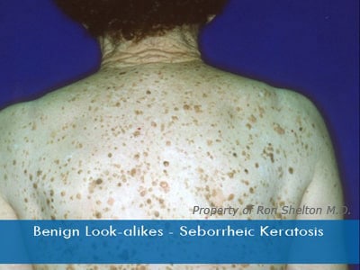 Seborrheic Keratosis Removal and treatment in NYC | Dr Ron Shelton