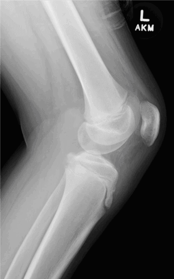 A 12-Year-Old Male with a 6-Month History of Knee Pain and Swelling ...