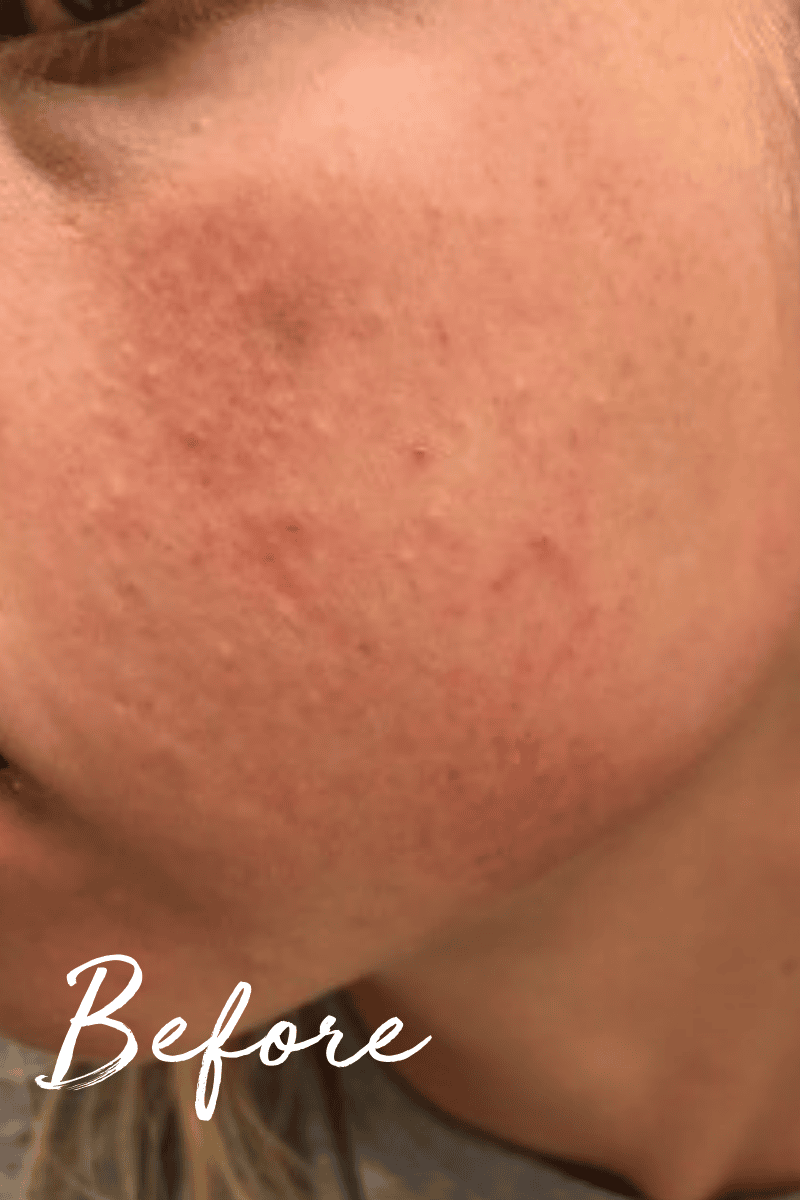 My Skin Story: How I naturally cleared my acne | The Healthy Consultant