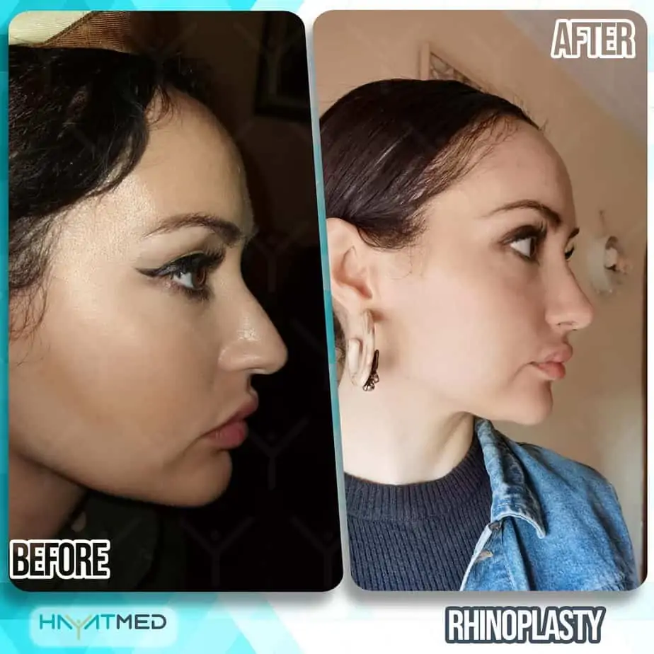 Best Nose Job In Turkey: Rhinoplasty In Turkey – PEKB