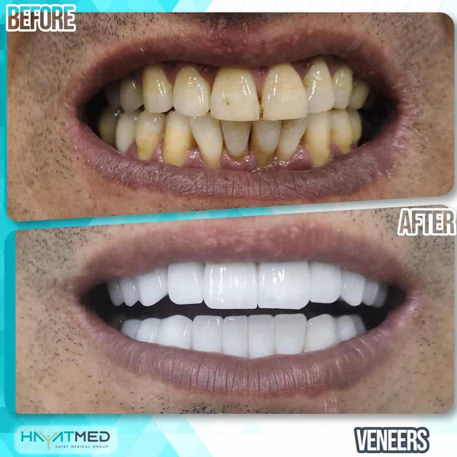 What Is Hollywood Smile? How To Get A Great, Attractive Smile