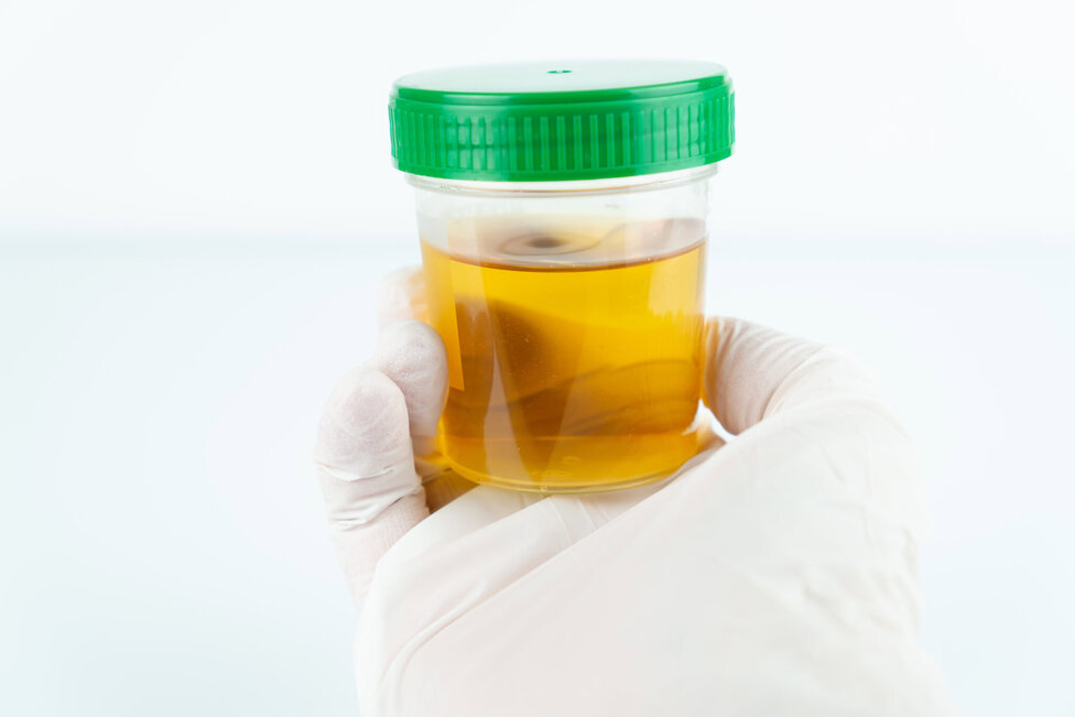 Comprendre l'ECBU : Tout sur l'examen cyto-bactériologique des urines