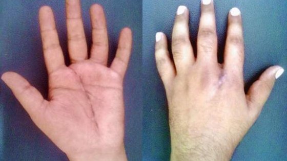Easy Hand Blast Injury Physiotherapy Exercise to Get back to job early