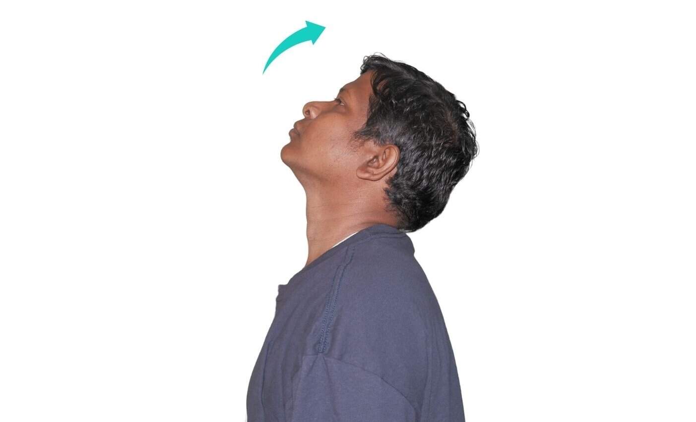 7 Easy Neck Exercises for Pinched nerve to Cure Cervical Radiculopathy ...