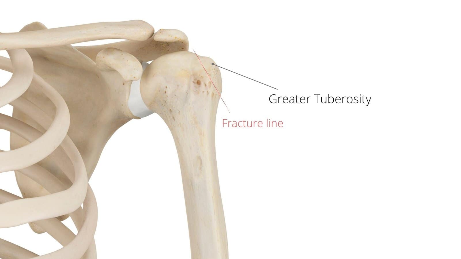 6 Easy Greater Tuberosity Fracture Rehabilitation Exercises