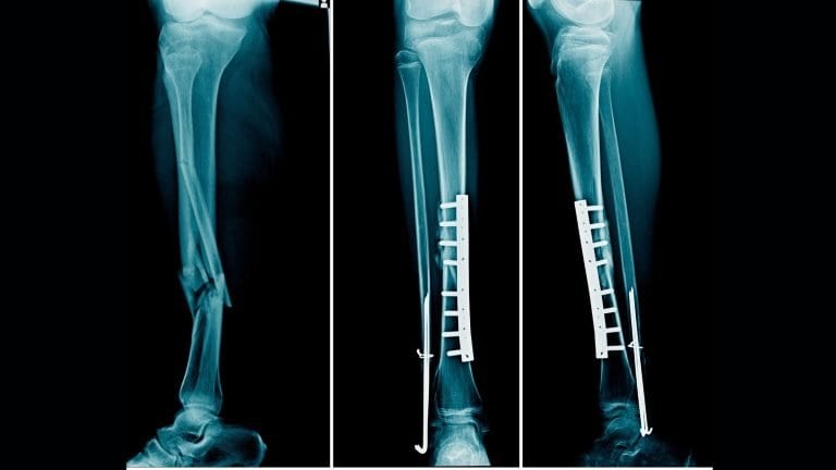Tibia Fibula Fracture Rehab Protocol, physiotherapy Exercises