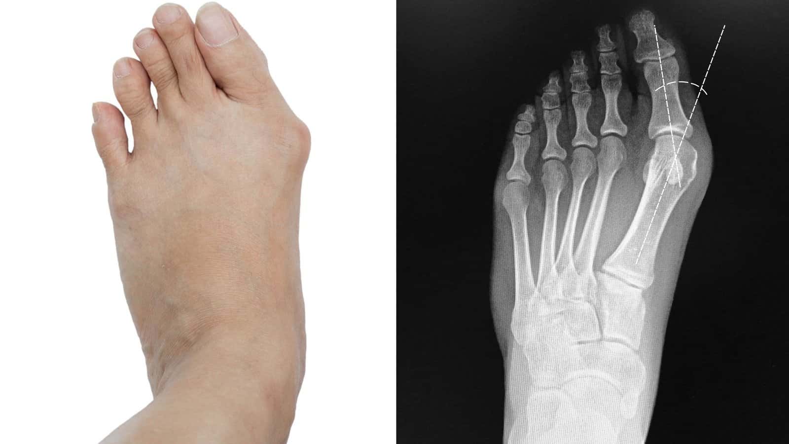 4 Easy Exercises for Hallux Valgus| Bunion Pain Relief in Great Toe