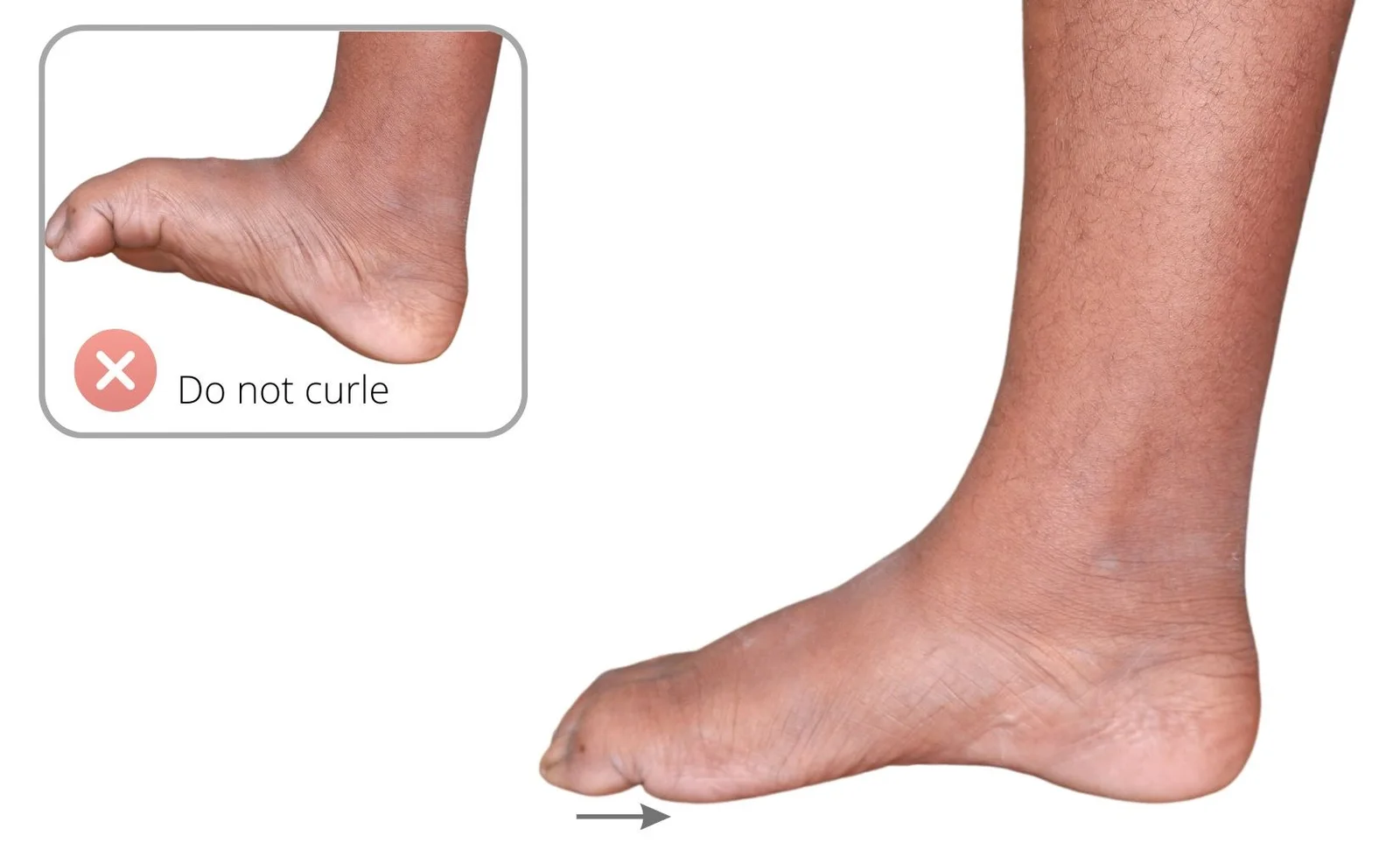 4 Easy Exercises for Hallux Valgus| Bunion Pain Relief in Great Toe