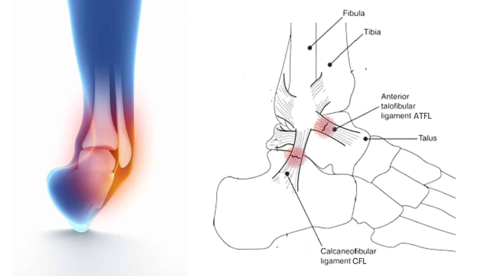7 Easy Ankle Sprain Exercises to Start Running Early| Surgical ...