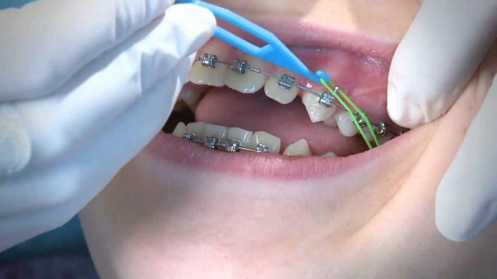 ¿Para qué sirven las gomas de los brackets? - Diente a diente