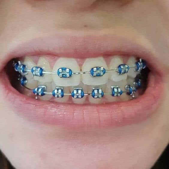 Brackets de colores: Cómo elegir el color perfecto - Diente a diente