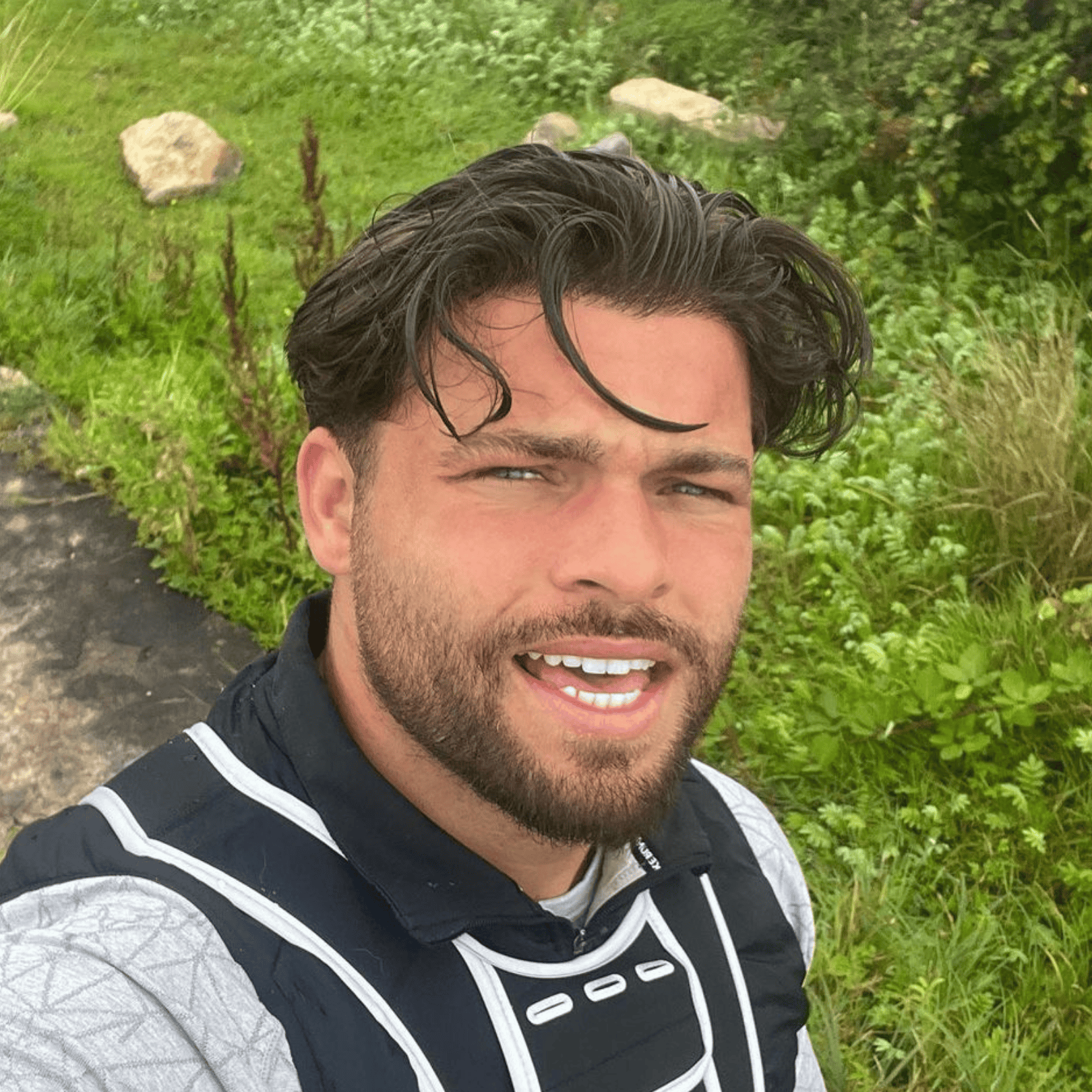 Jake Cornish Hair Transplant at KSL Clinic // See the results here