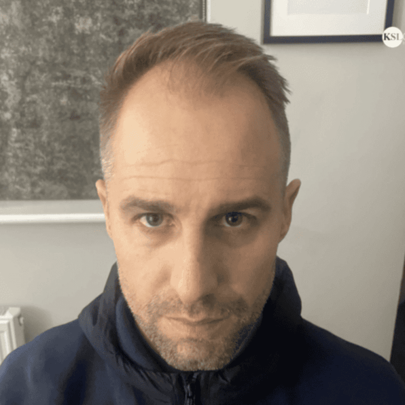 Receding Hairline Stages: The Seven Stages of Baldness