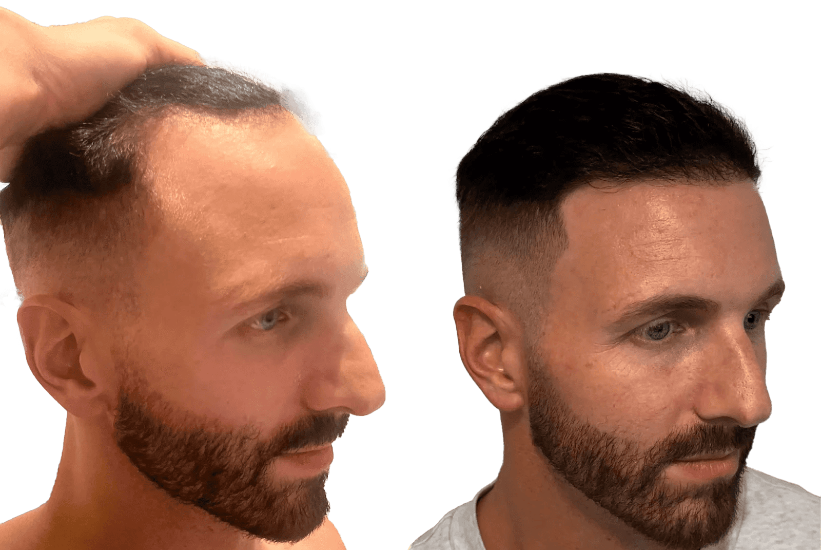 Why Is My Hair Receding on One Side?