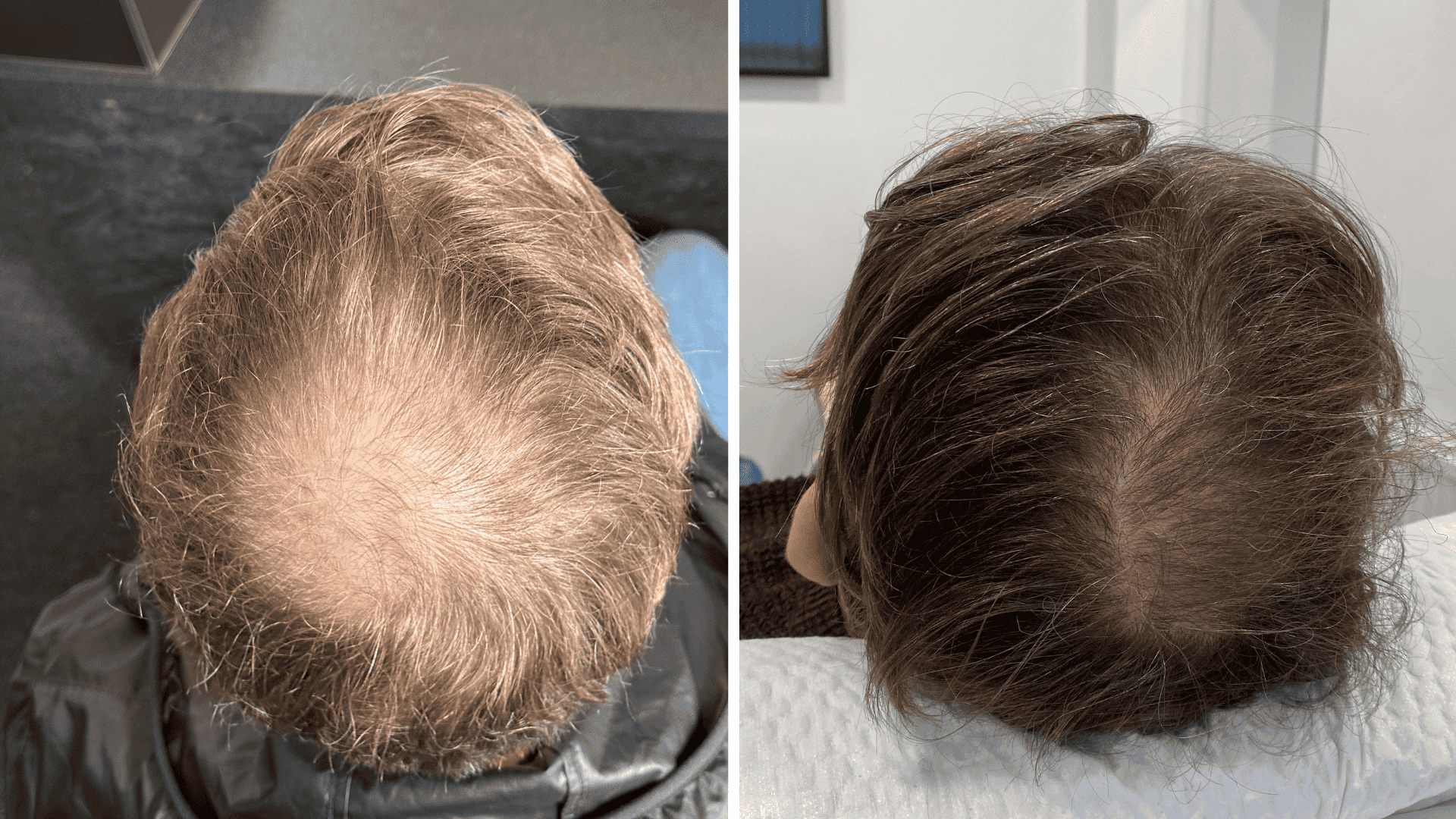 How Much Does PRP Cost? PRP Prices Explained