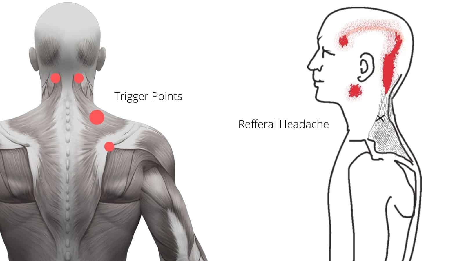 7 Home Exercises for Cervicogenic Headaches That Actually Work