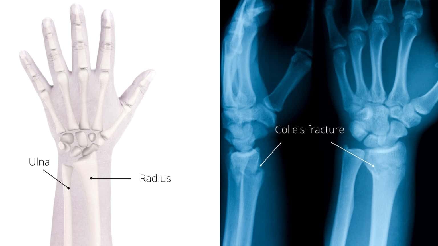 How to Exercise after Colles' Fracture to regain wrist movement and ...