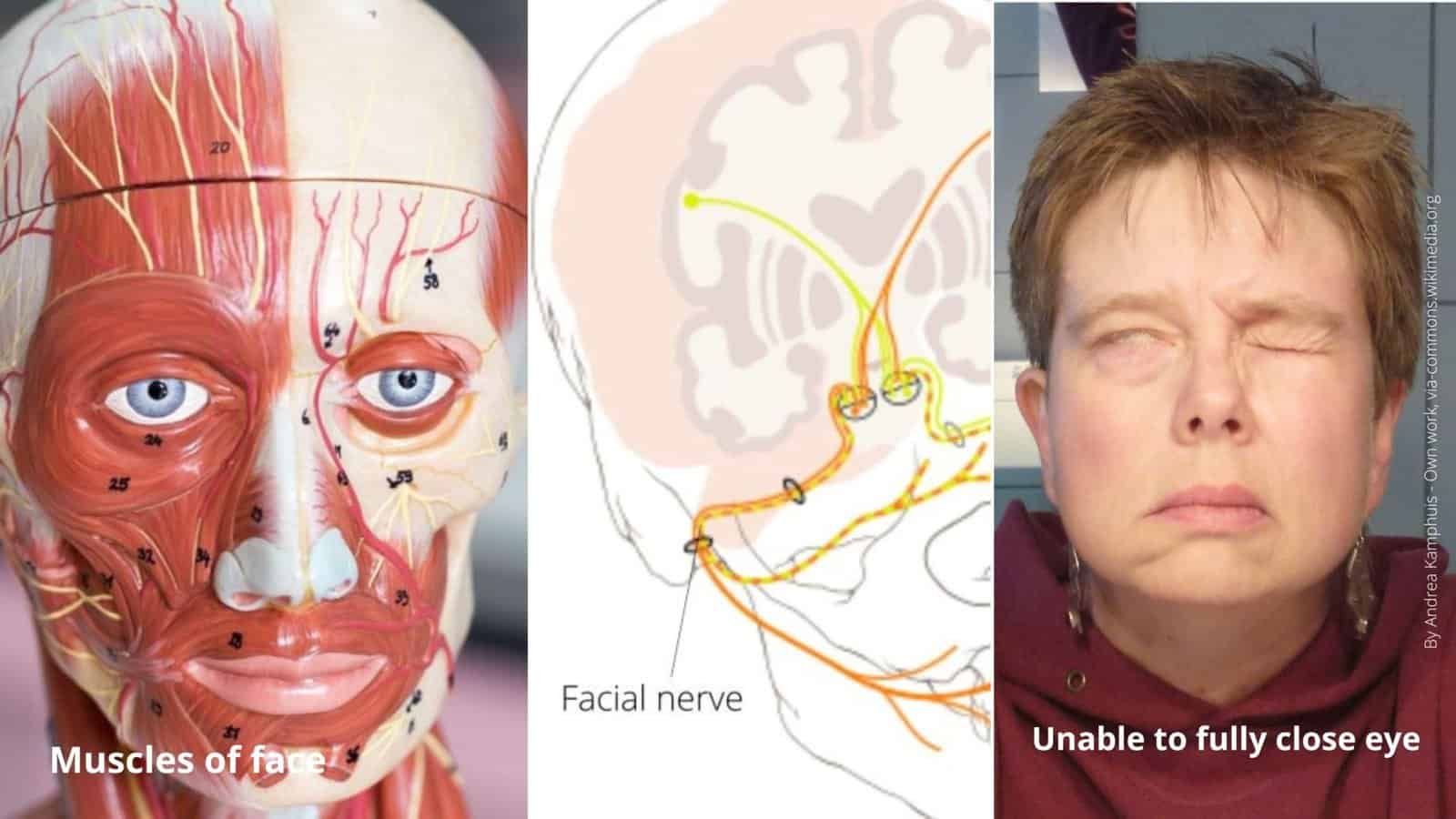 11 Easy Bell's Palsy Exercises for Facial Weakness