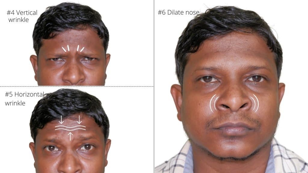 11 Easy Bell's Palsy Exercises for Facial Weakness