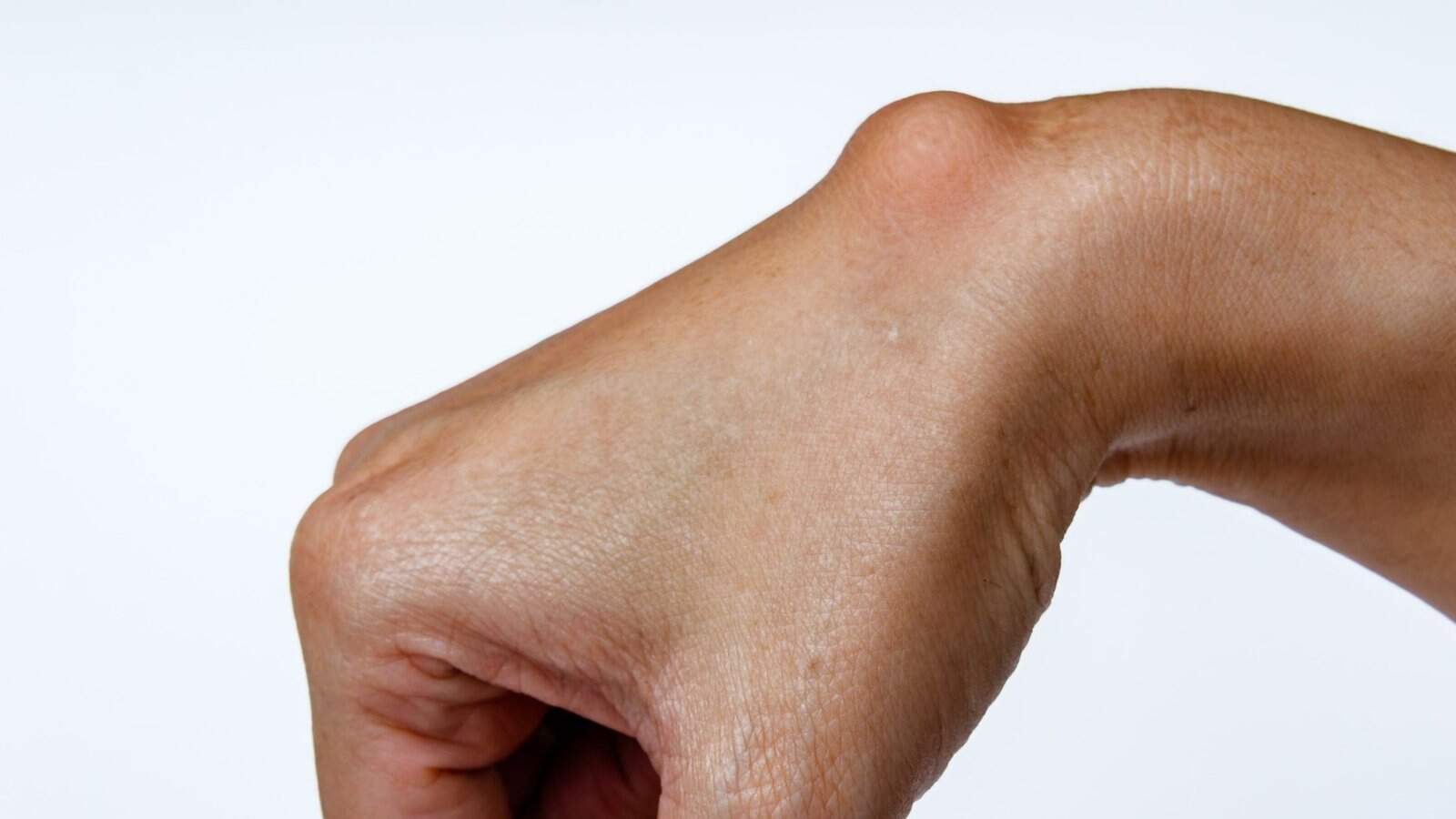 These 3 Easy Ganglion Cyst Wrist Exercises will Remove Lump Without Surgery