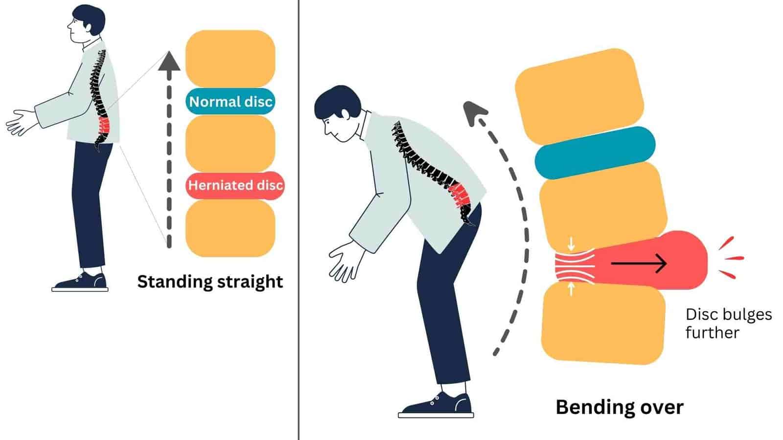 Disc Bulge and Why Bending Forward is Not Advised: Understanding the ...