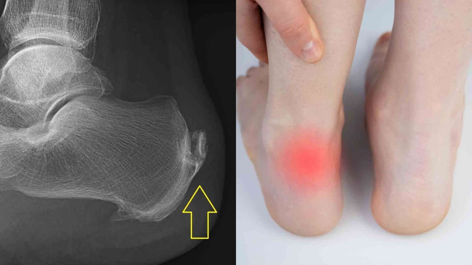 Calcification in Achilles Tendon: Causes, treatment & physiotherapy
