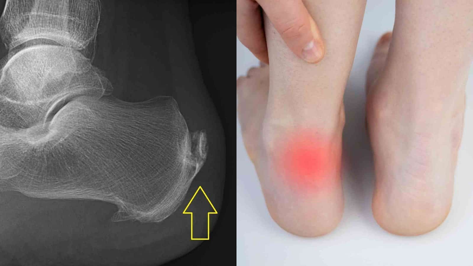 Calcification in Achilles Tendon: Causes, treatment & physiotherapy
