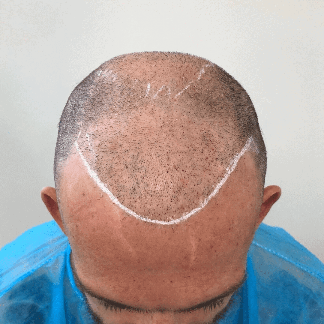 Steven Fletcher Hair Transplant at KSL Clinic // See the results here