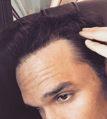 Gareth Gates Hair Transplant at KSL Clinic // See the results here