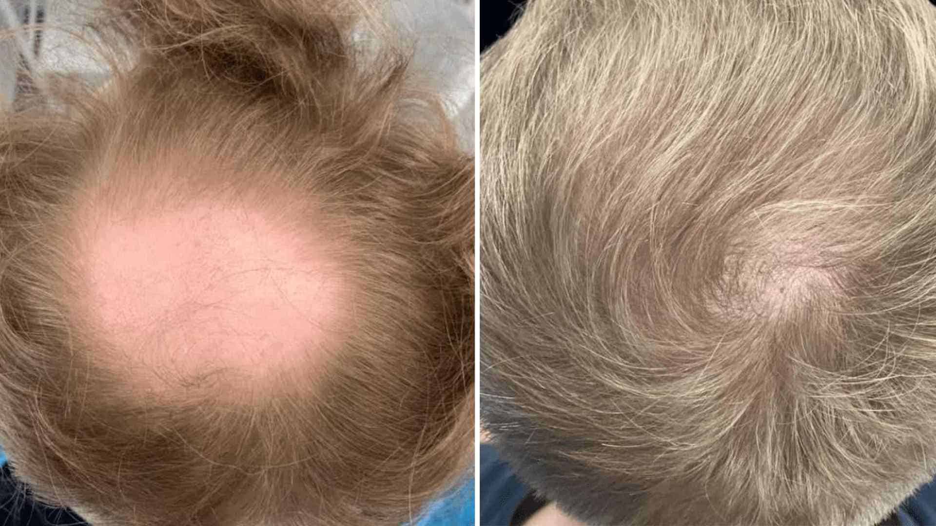 Receding Hairline Stages: The Seven Stages of Baldness